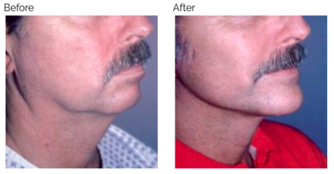 Before and After | Surgical Facelift - Victor Liu, MD