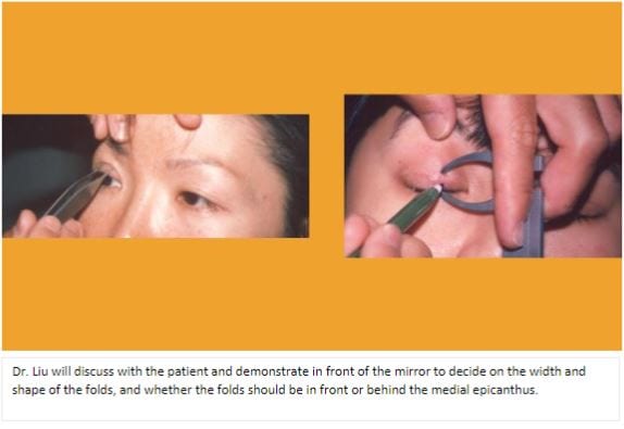 Eyelid and Brow Lift - Victor Liu, MD