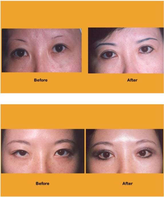 Eyelid and Brow Lift - Victor Liu, MD